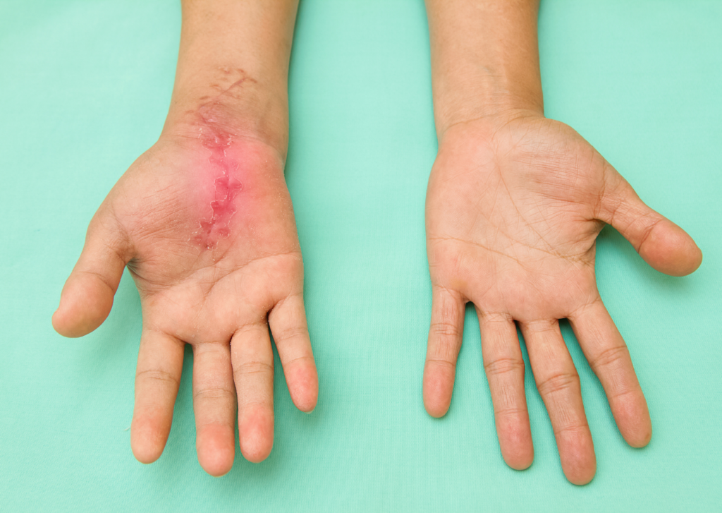 Pijnlijk litteken | Verhelp dit snel en doeltreffend met Edula® zalf!