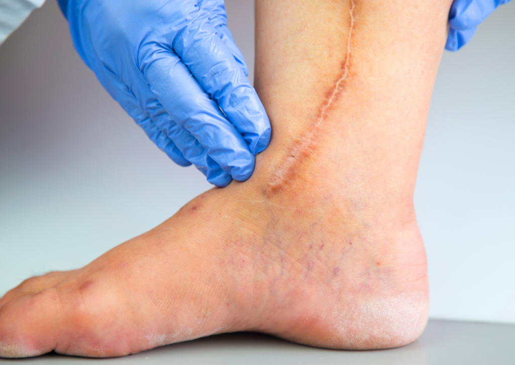 Jeuk litteken na operatie | Edula® zalf | Veilig en natuurlijk!