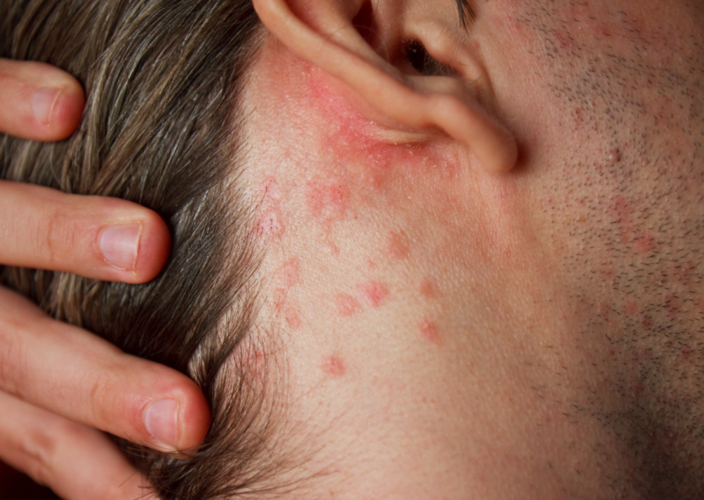 Uitslag op de huid: Wat zijn de oorzaken en wat doe je eraan?