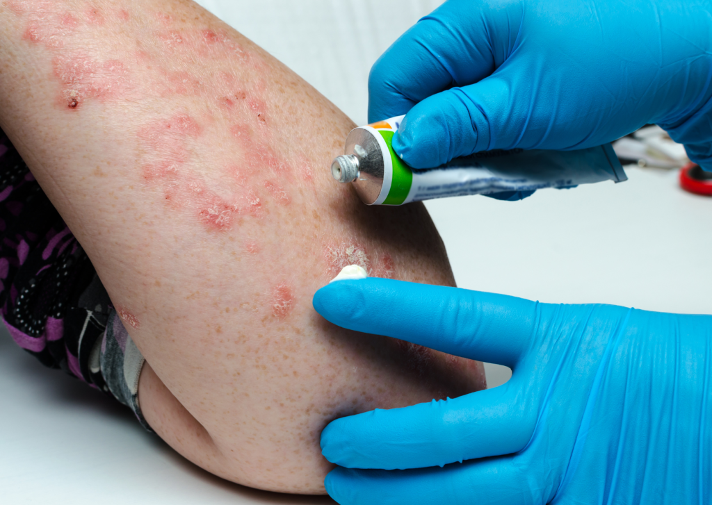 Eczeem crème: Wat is het en wat doet het voor je huid?