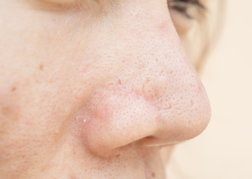 Litteken neus: Alles wat je erover moet weten