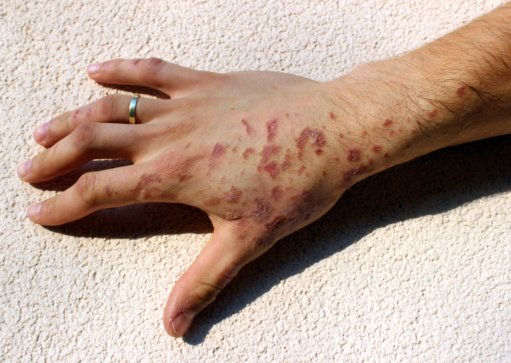 Litteken brandwond: Hoe verloopt het proces?