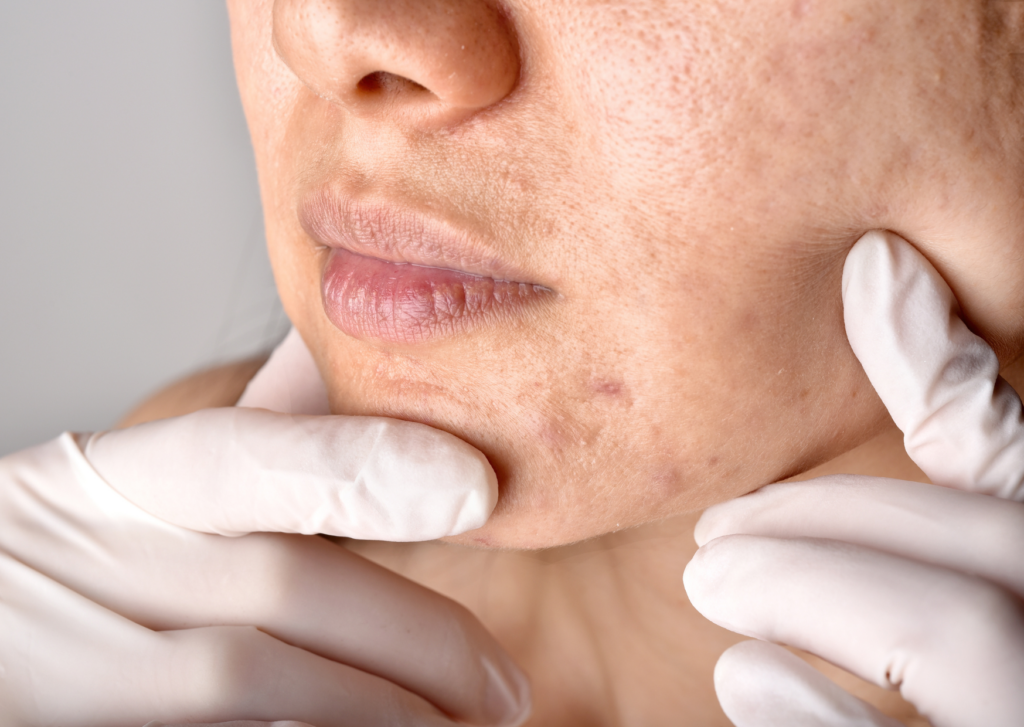 Littekencorrectie gezicht: Dit zijn de effecten