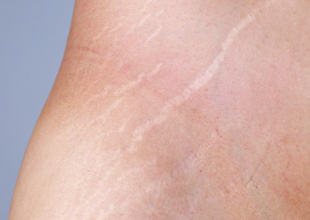 Litteken verwijderaar: Bestaat er een makkelijke methode?