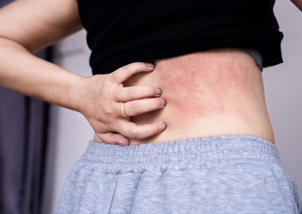 Jeukend litteken | Wat is de beste manier van behandelen?